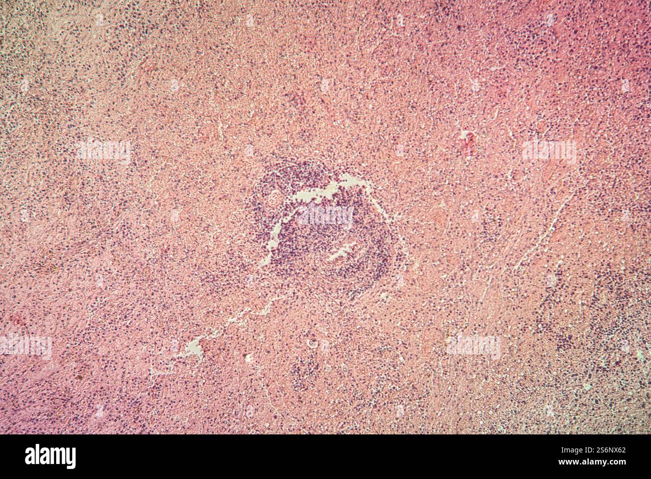 Scars in the heart muscle 100x Stock Photo - Alamy