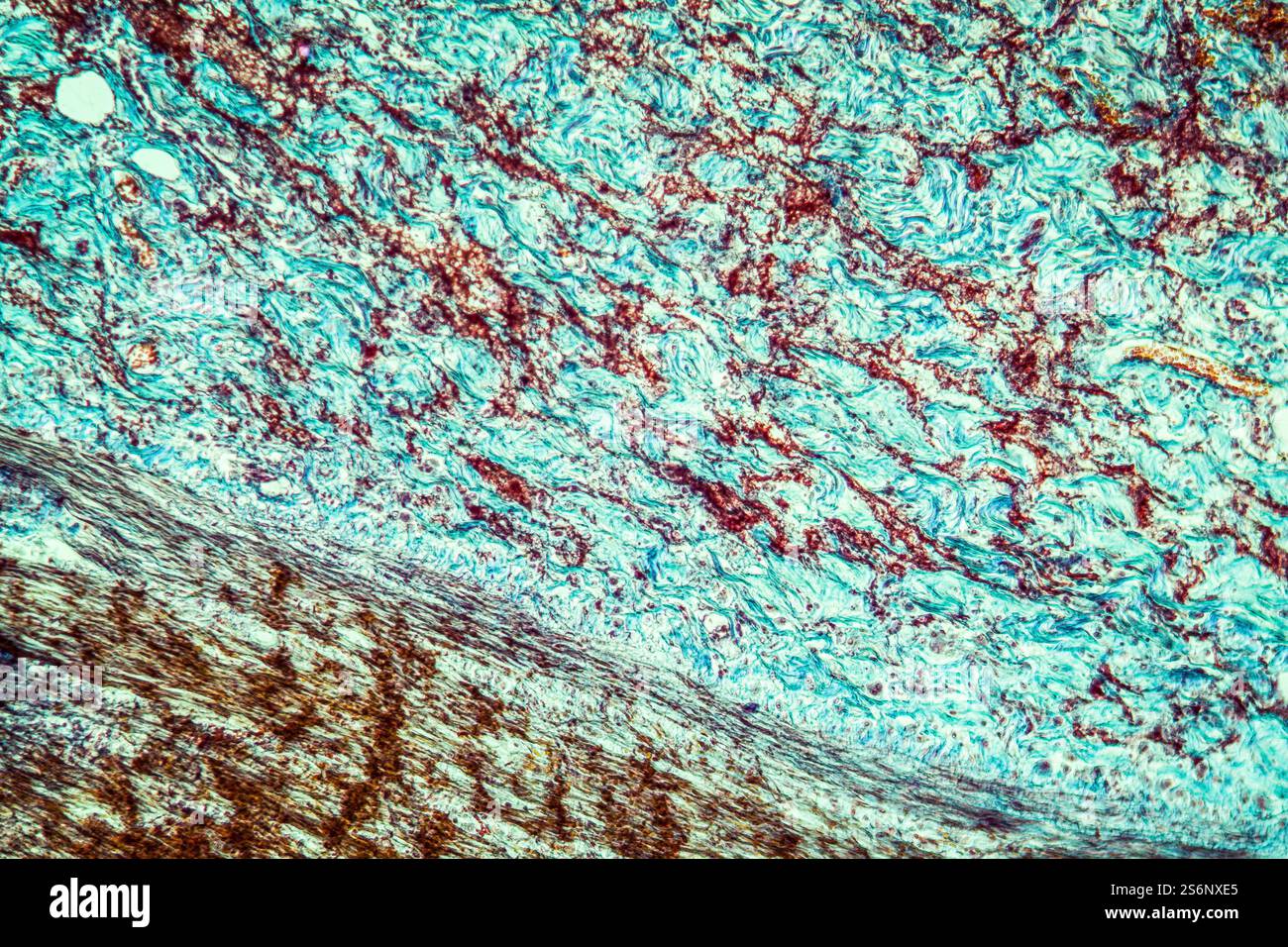 Large intestine diseased tissue hi-res stock photography and images - Alamy