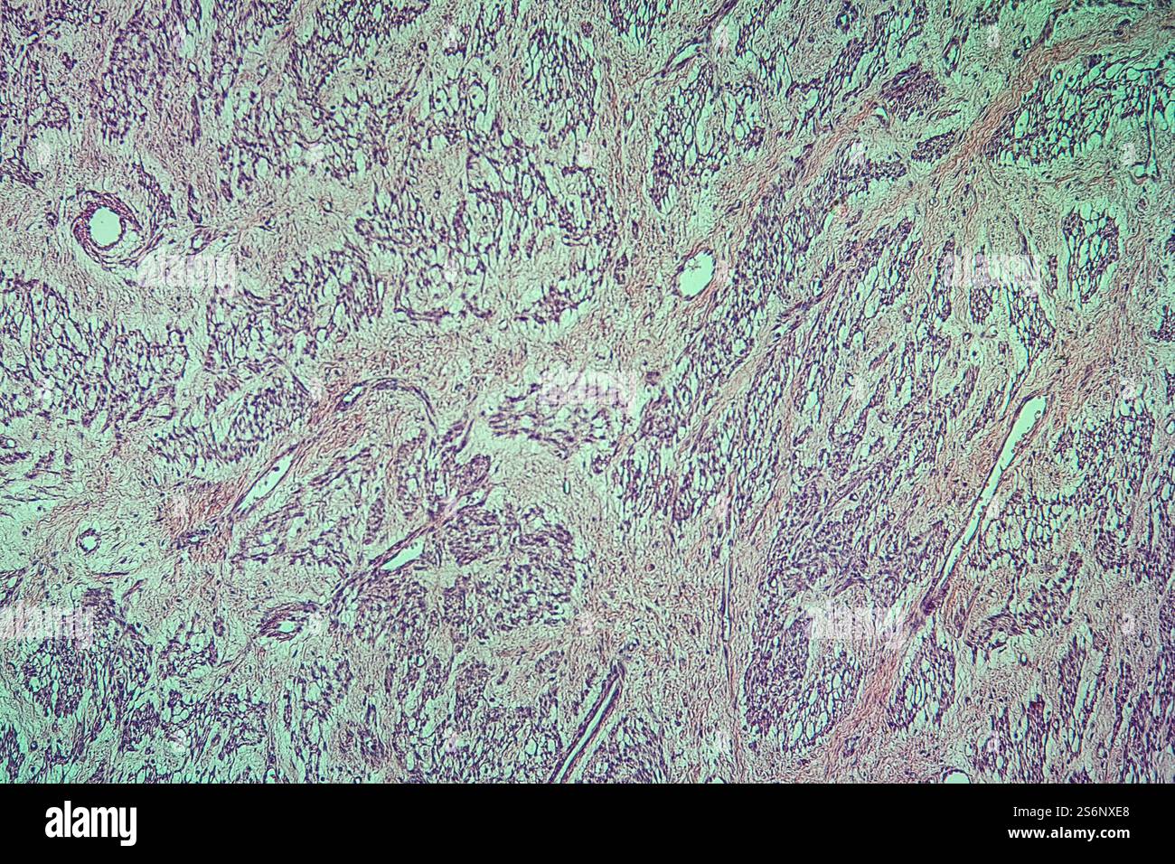 Uterus diseased tissue 100x Stock Photo - Alamy