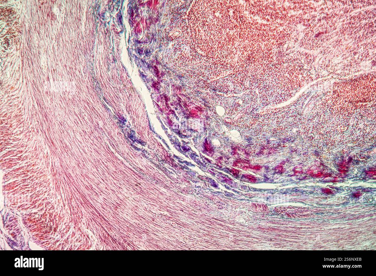 Appendix diseased tissue 100x Stock Photo - Alamy