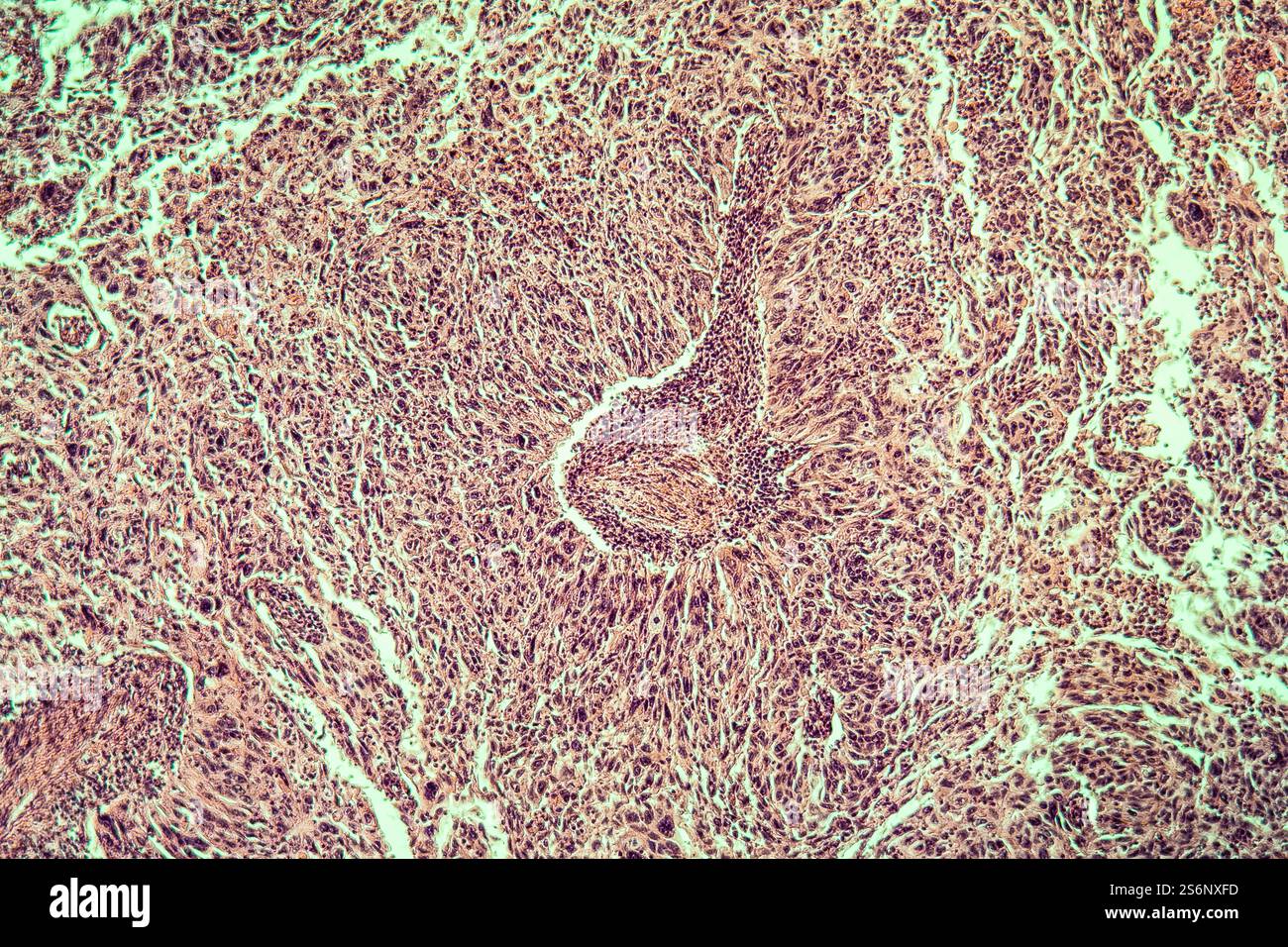Uterus diseased tissue 100x Stock Photo - Alamy