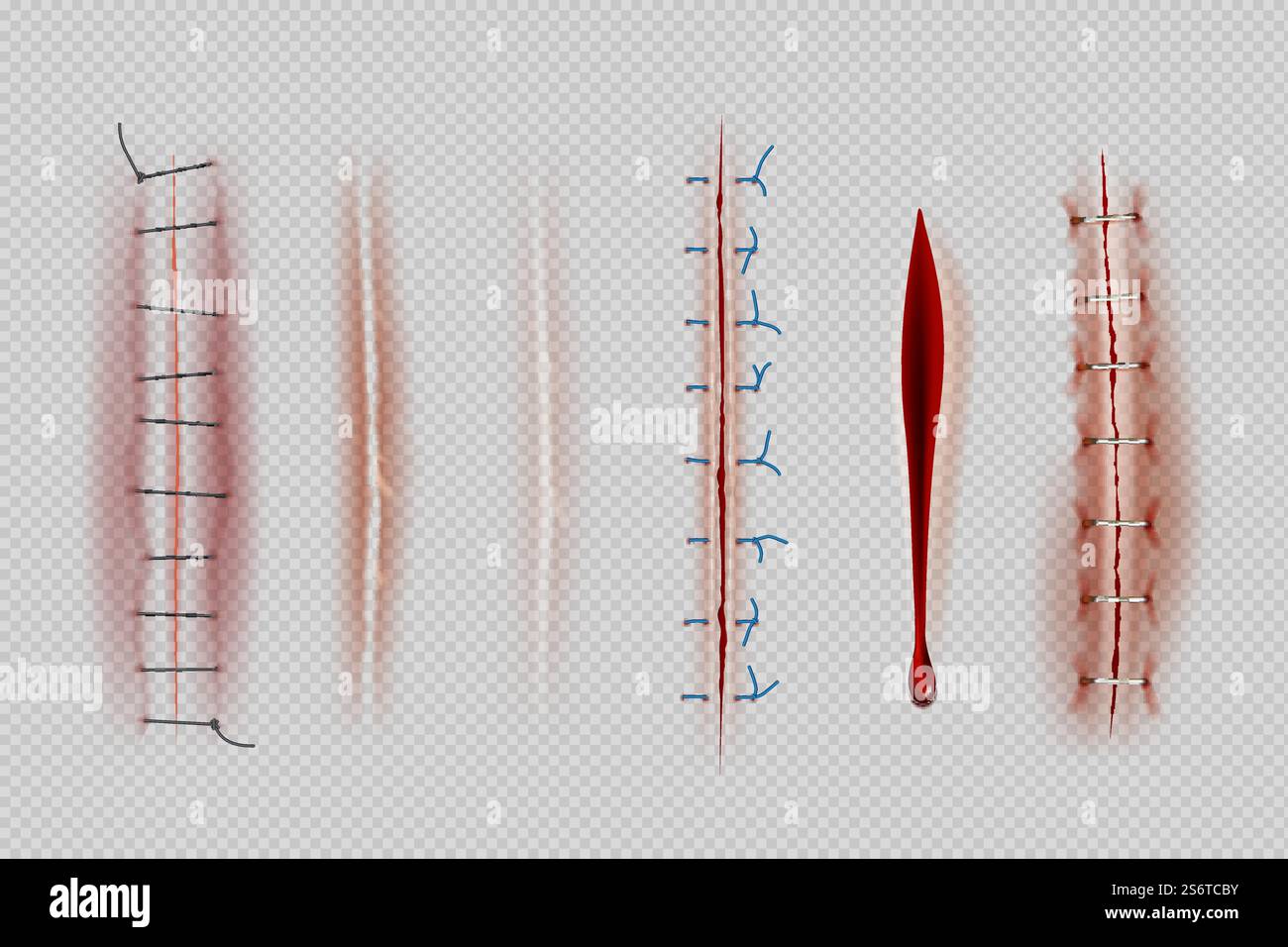 Surgical sutures. Medical closeup stitches scars and wounds decent vector realistic ...