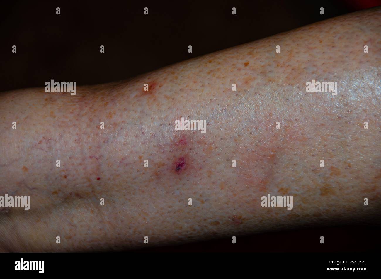 Dog bite wound hi-res stock photography and images - Alamy