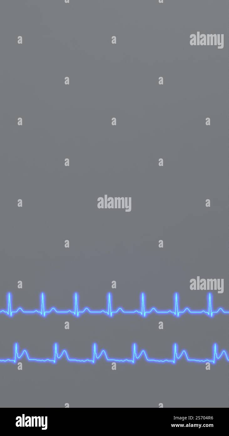 ECG comparison of the normal heart rhythm of a healthy patient and the ...