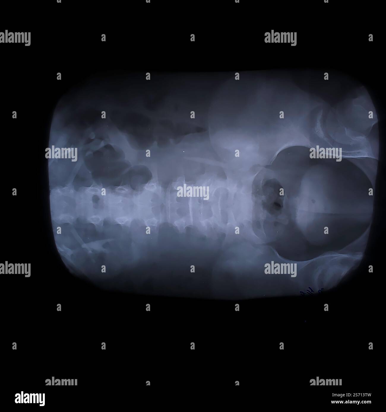 A Detailed Radiographic Analysis of the Lumbar Spine for Clinical and ...