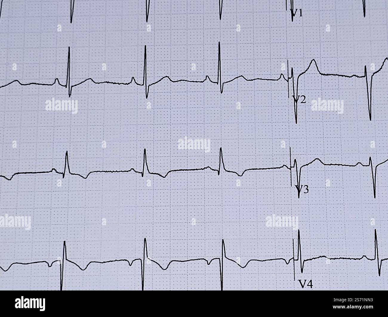 ECG ElectroCardioGraph paper that shows inferolateral T wave changes for clinical correlation ...
