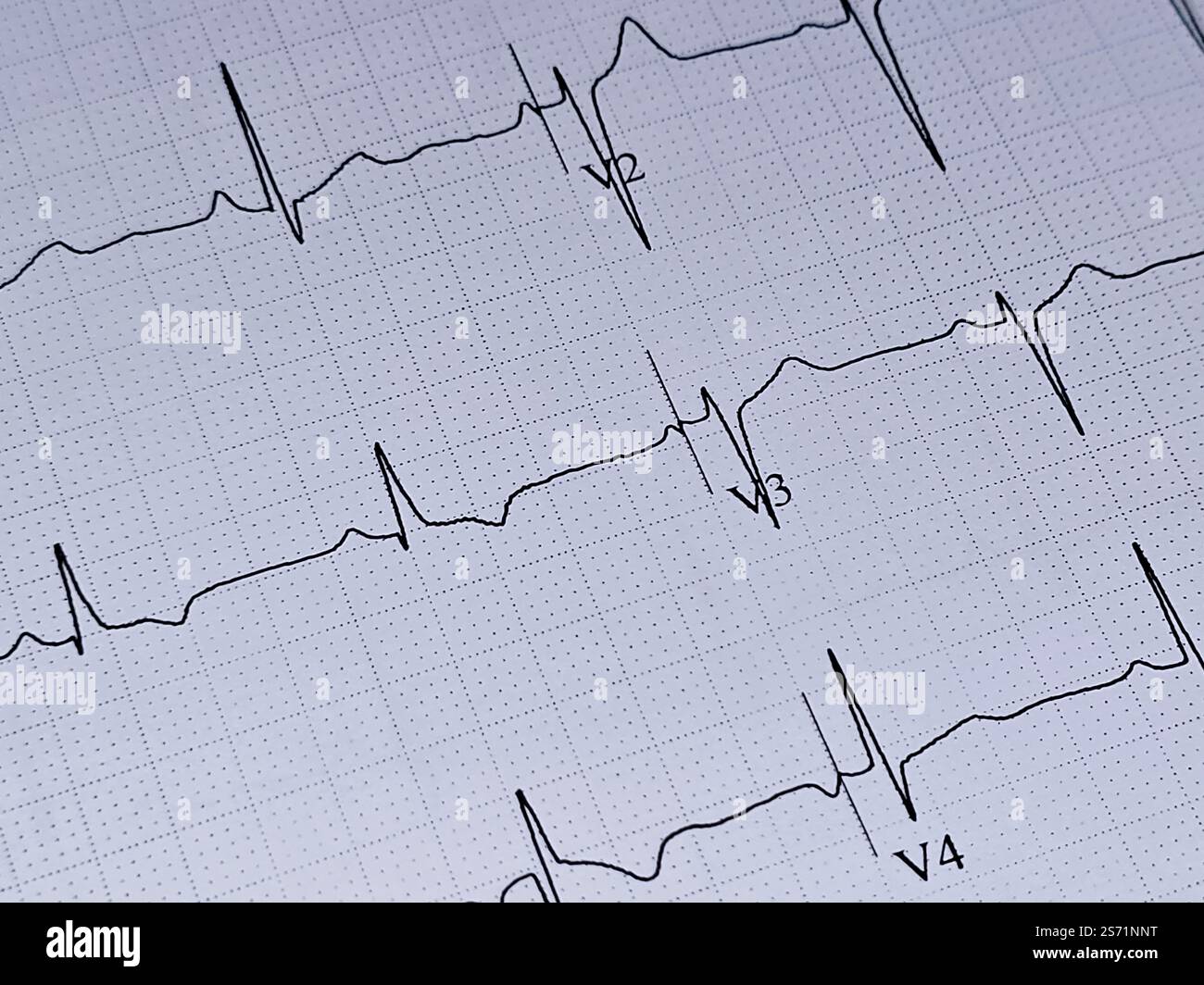 ECG ElectroCardioGraph paper that shows inferolateral T wave changes for clinical correlation ...