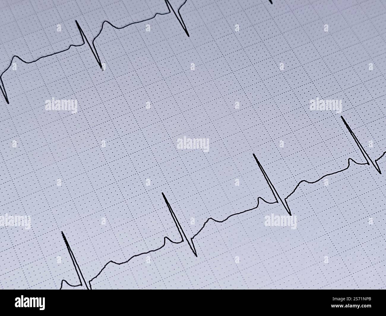 ECG ElectroCardioGraph paper that shows inferolateral T wave changes ...