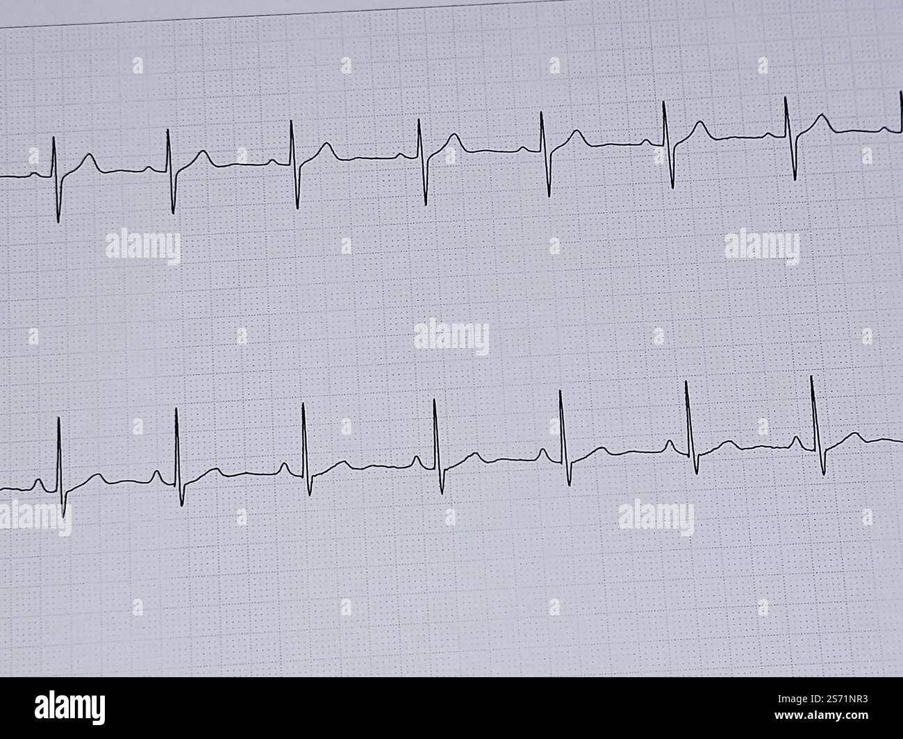 ECG ElectroCardioGraph paper that shows inferolateral T wave changes ...