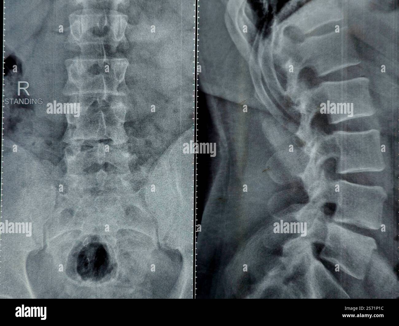 X-ray lumbosacral spine shows straightening of lumbar lordosis due to ...