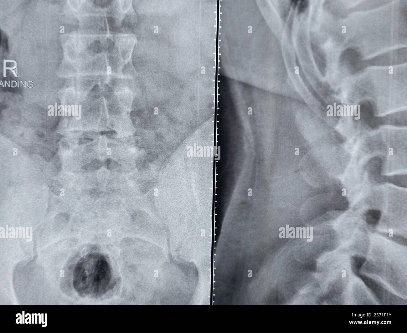 X-ray lumbosacral spine shows straightening of lumbar lordosis due to ...