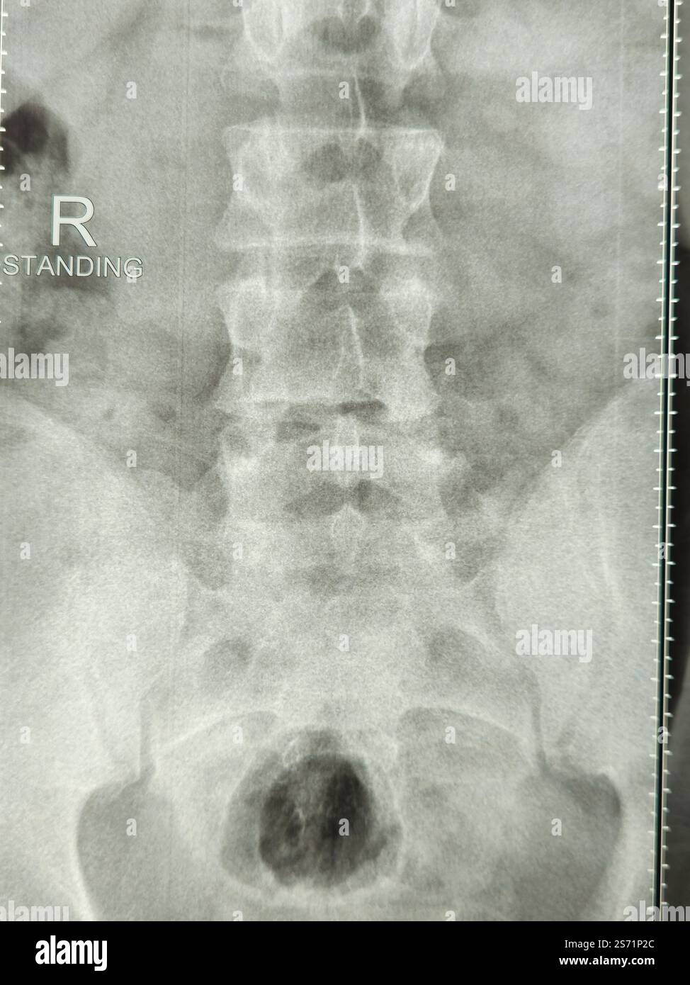 X-ray lumbosacral spine shows straightening of lumbar lordosis due to ...