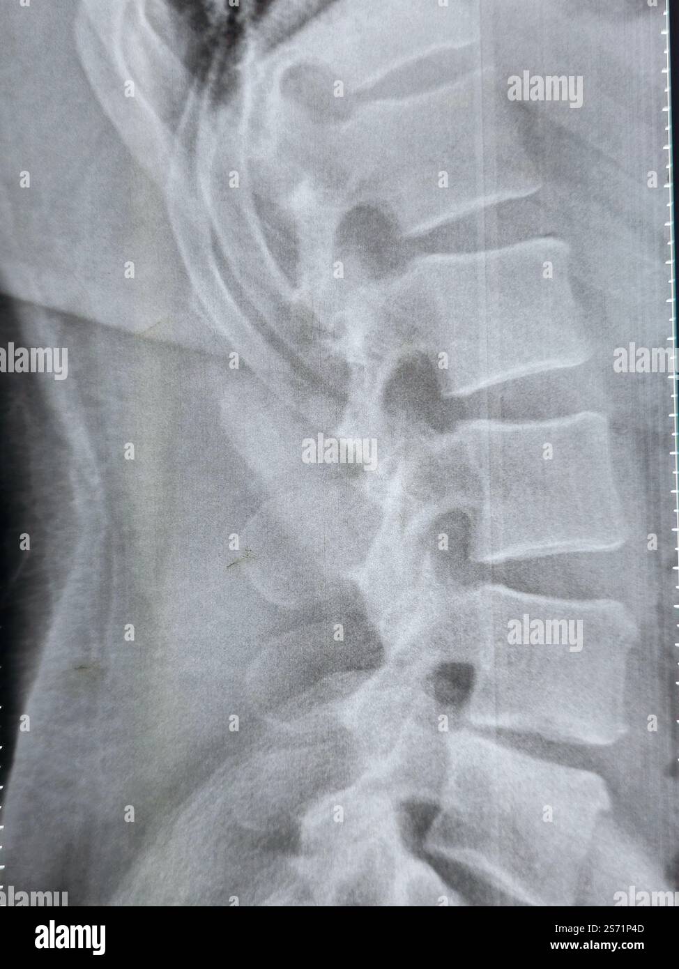 X-ray lumbosacral spine shows straightening of lumbar lordosis due to ...