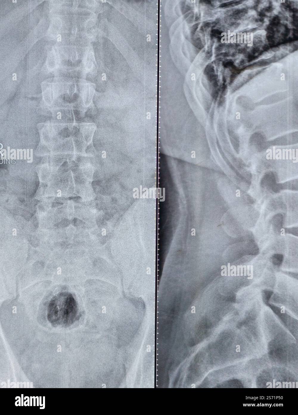 X-ray lumbosacral spine shows straightening of lumbar lordosis due to ...