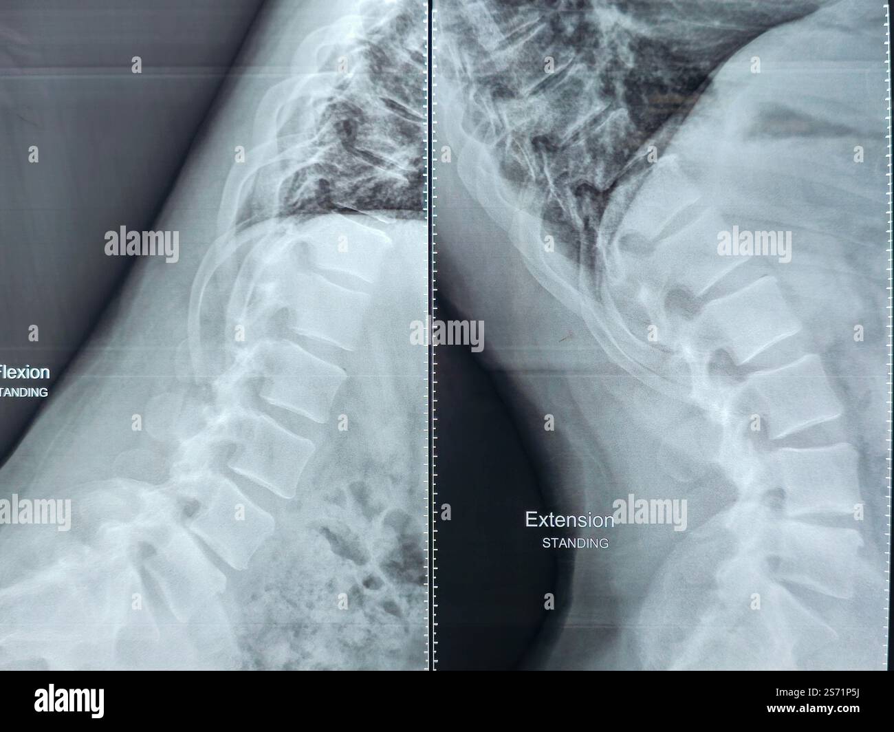 X-ray lumbosacral spine shows straightening of lumbar lordosis due to ...