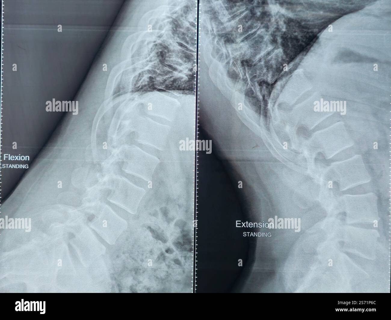 X-ray lumbosacral spine shows straightening of lumbar lordosis due to ...