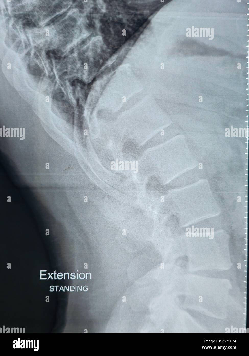 X-ray lumbosacral spine shows straightening of lumbar lordosis due to ...
