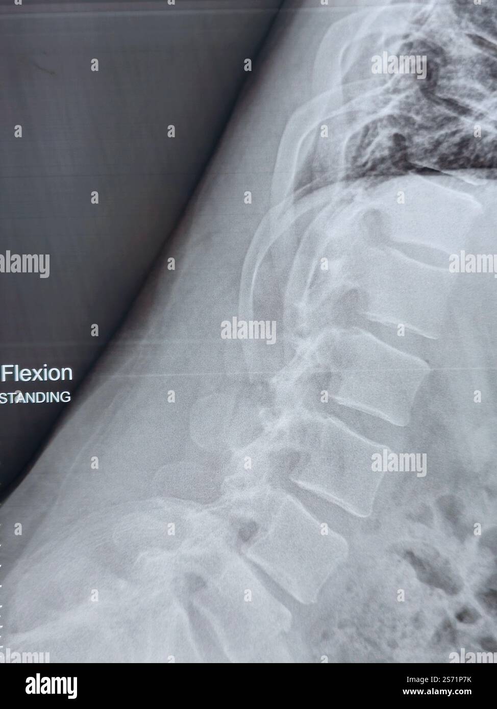 X-ray lumbosacral spine shows straightening of lumbar lordosis due to ...