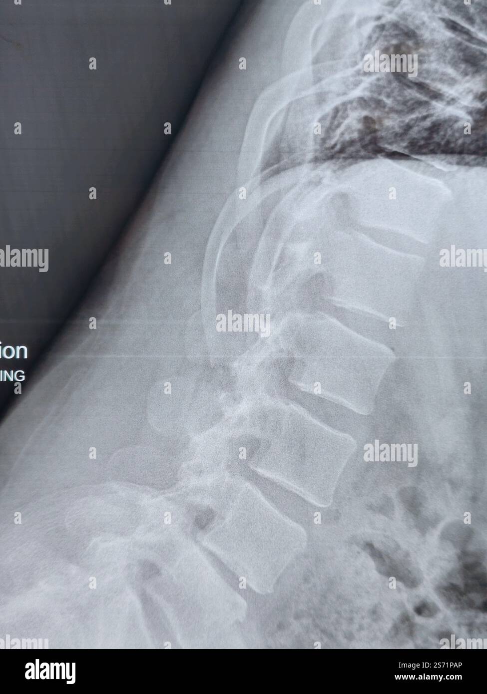 X-ray lumbosacral spine shows straightening of lumbar lordosis due to ...