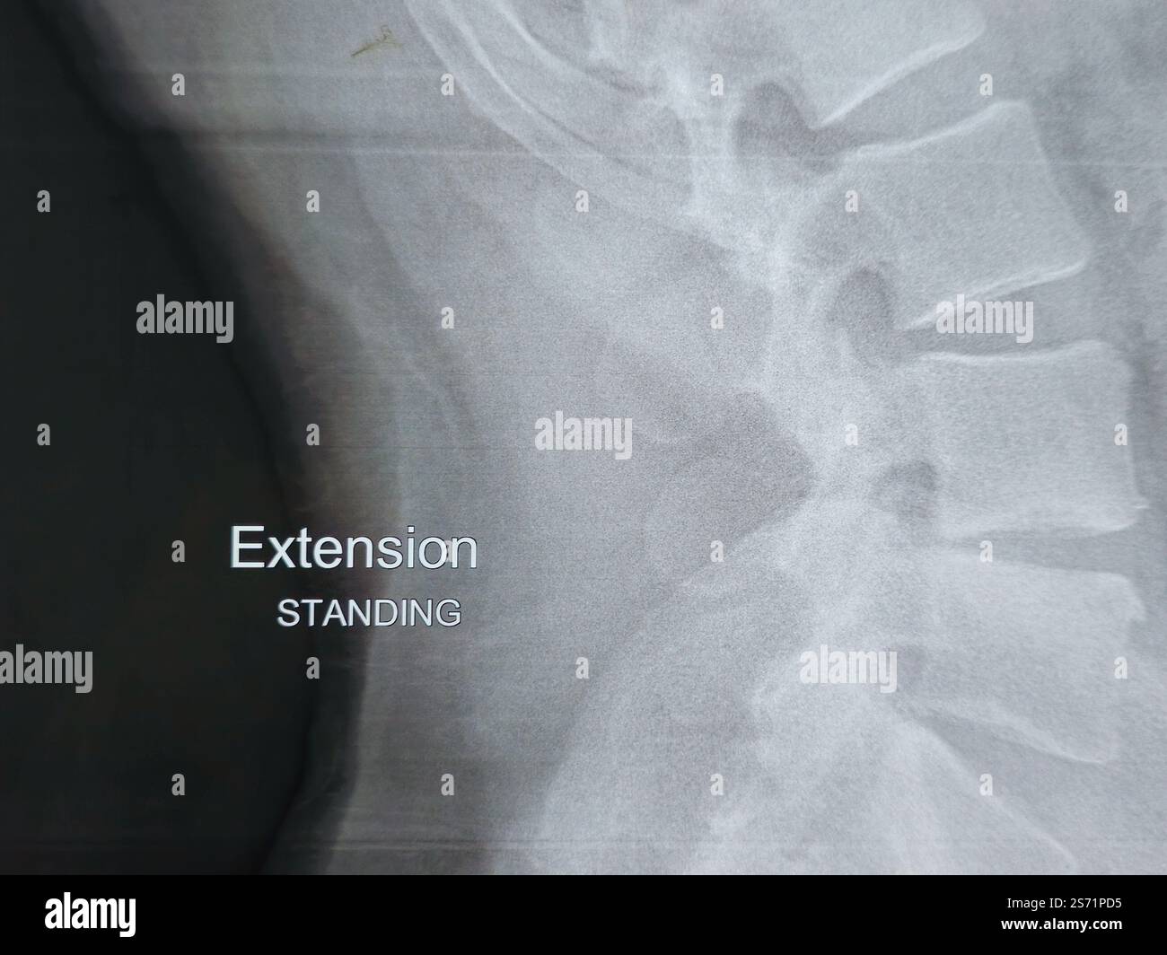 X-ray lumbosacral spine shows straightening of lumbar lordosis due to ...