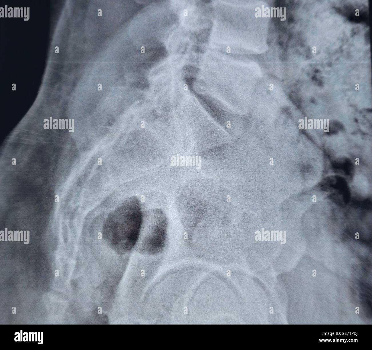 X-ray lumbosacral spine shows straightening of lumbar lordosis due to ...