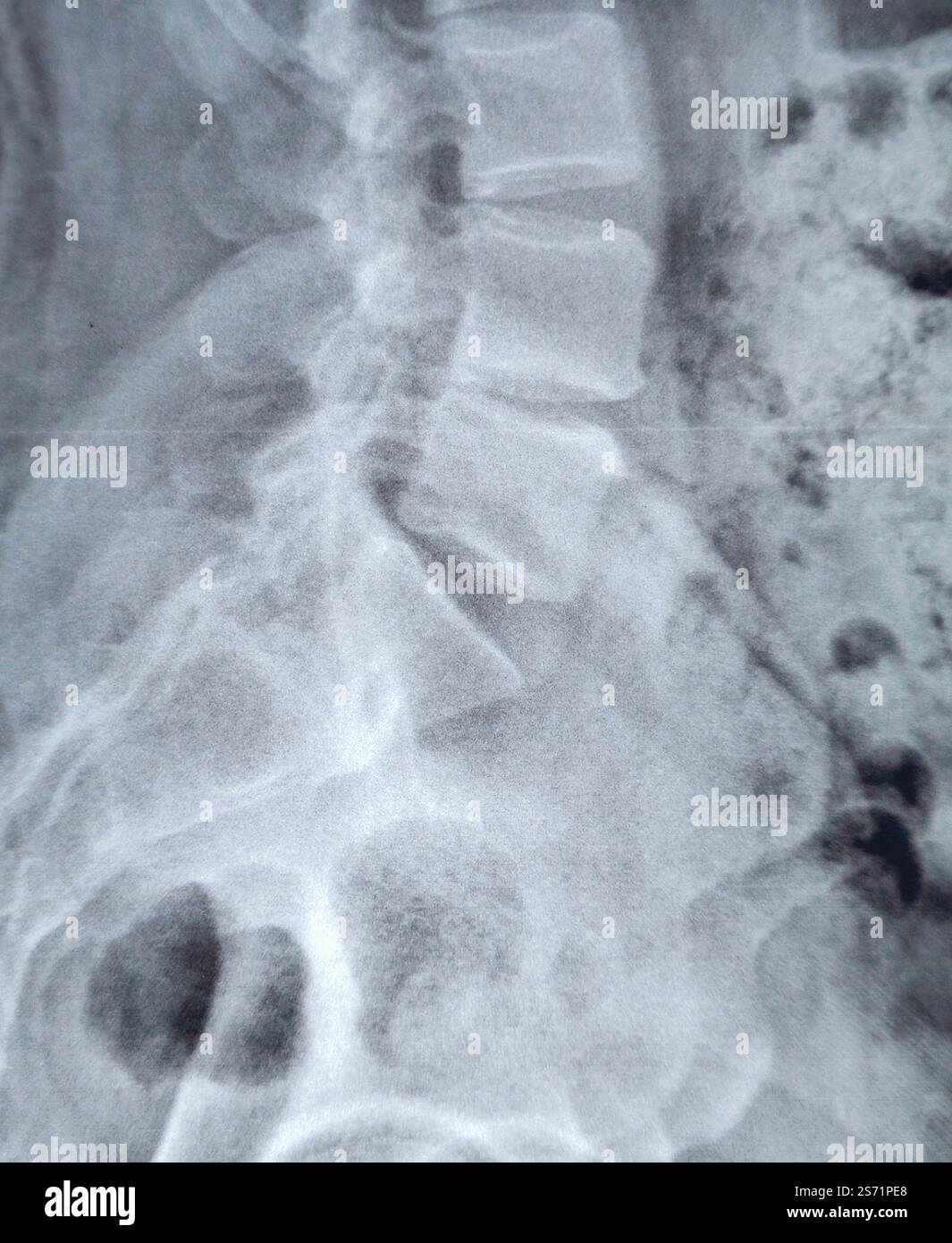 X-ray lumbosacral spine shows straightening of lumbar lordosis due to ...