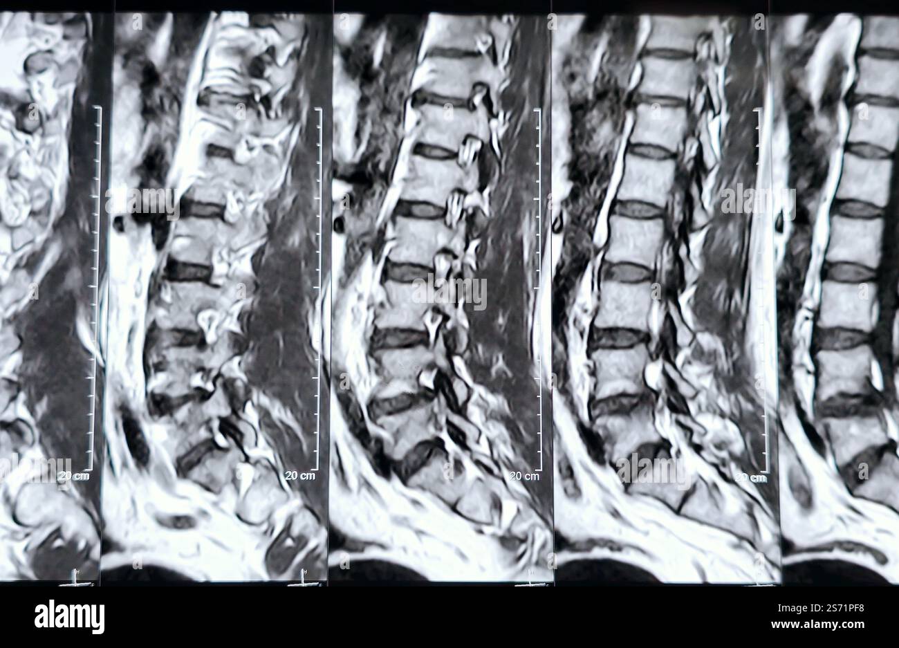 Magnetic Resonance Imaging MRI of the lumbosacral spine shows ...