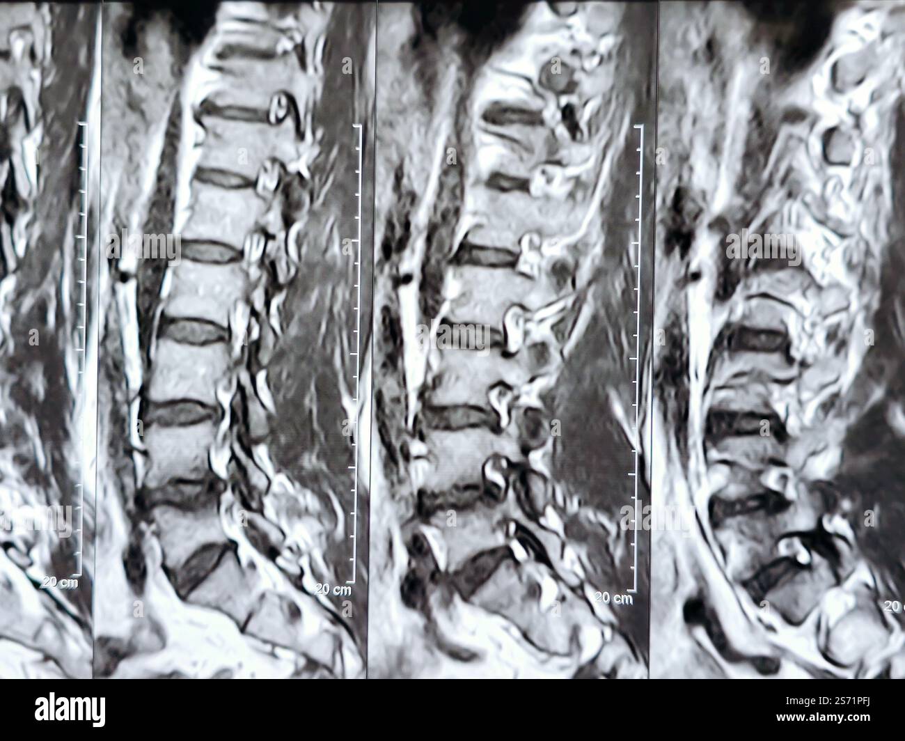 Magnetic Resonance Imaging MRI of the lumbosacral spine shows ...