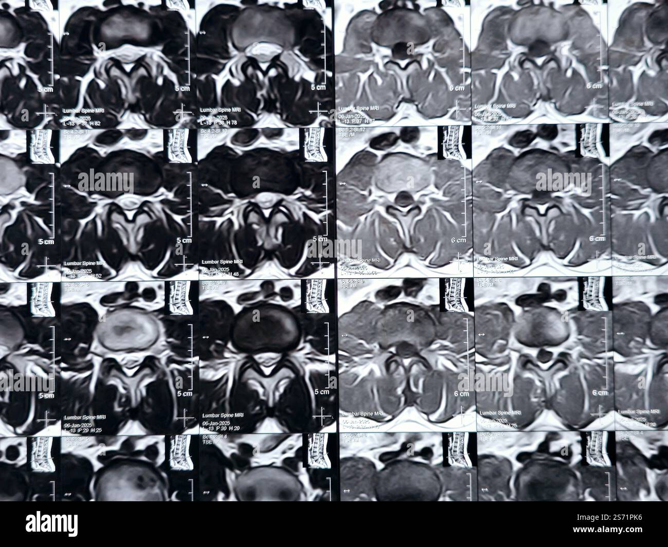 Magnetic Resonance Imaging MRI of the lumbosacral spine shows ...