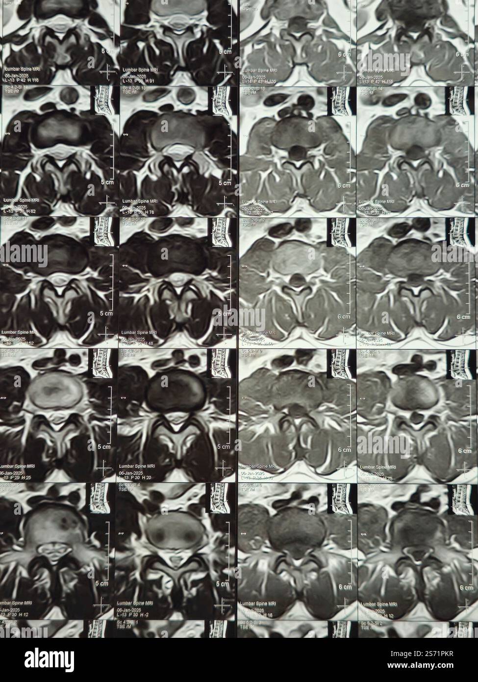 Magnetic Resonance Imaging MRI of the lumbosacral spine shows ...