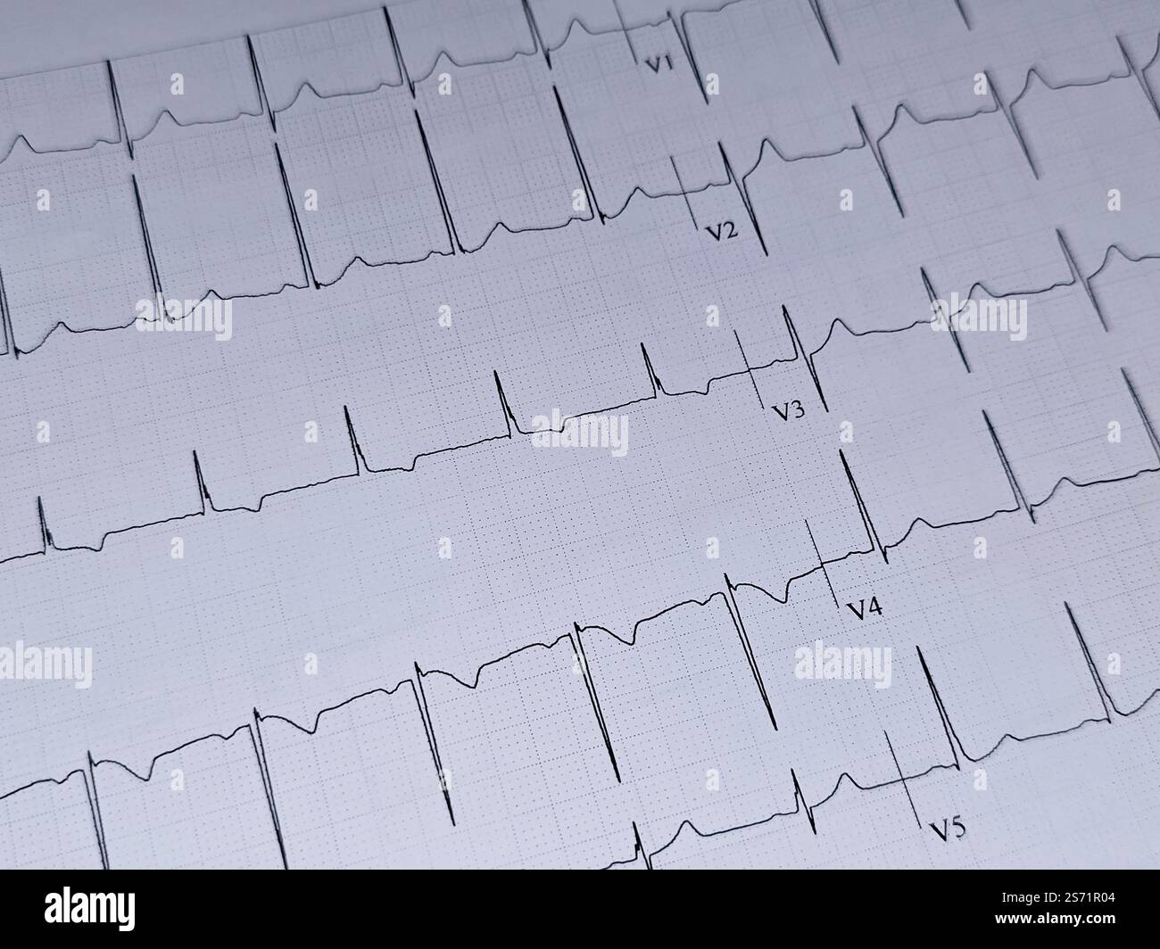 an electrocardiogram ECG or EKG, within normal ECG for a 55 years old ...