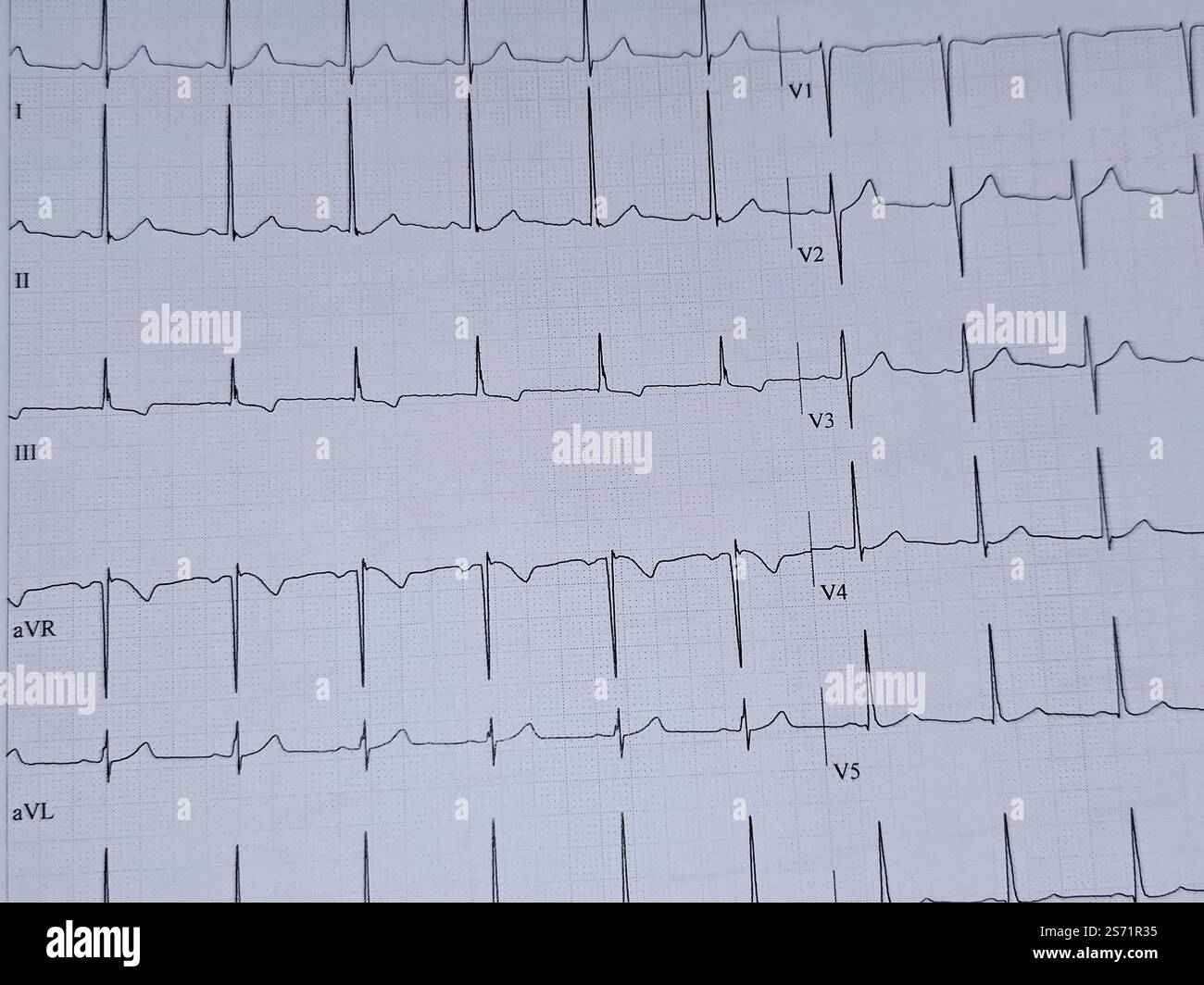 An Electrocardiogram Ecg Or Ekg Within Normal Ecg For A 55 Years Old
