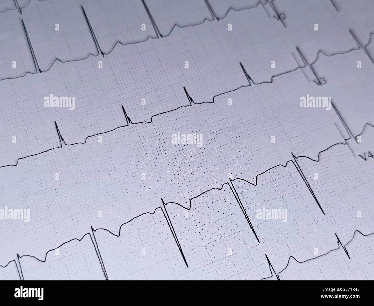 An Electrocardiogram Ecg Or Ekg Within Normal Ecg For A 55 Years Old