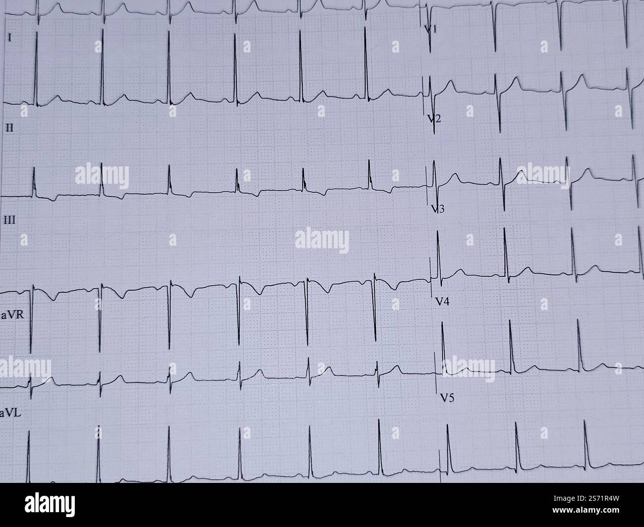 An Electrocardiogram Ecg Or Ekg Within Normal Ecg For A 55 Years Old