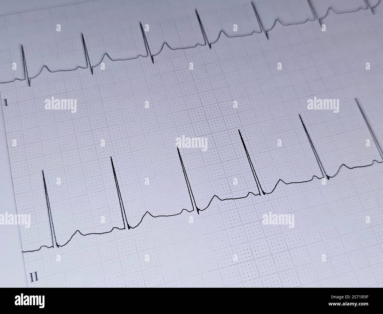 Normal ecg hi-res stock photography and images - Alamy