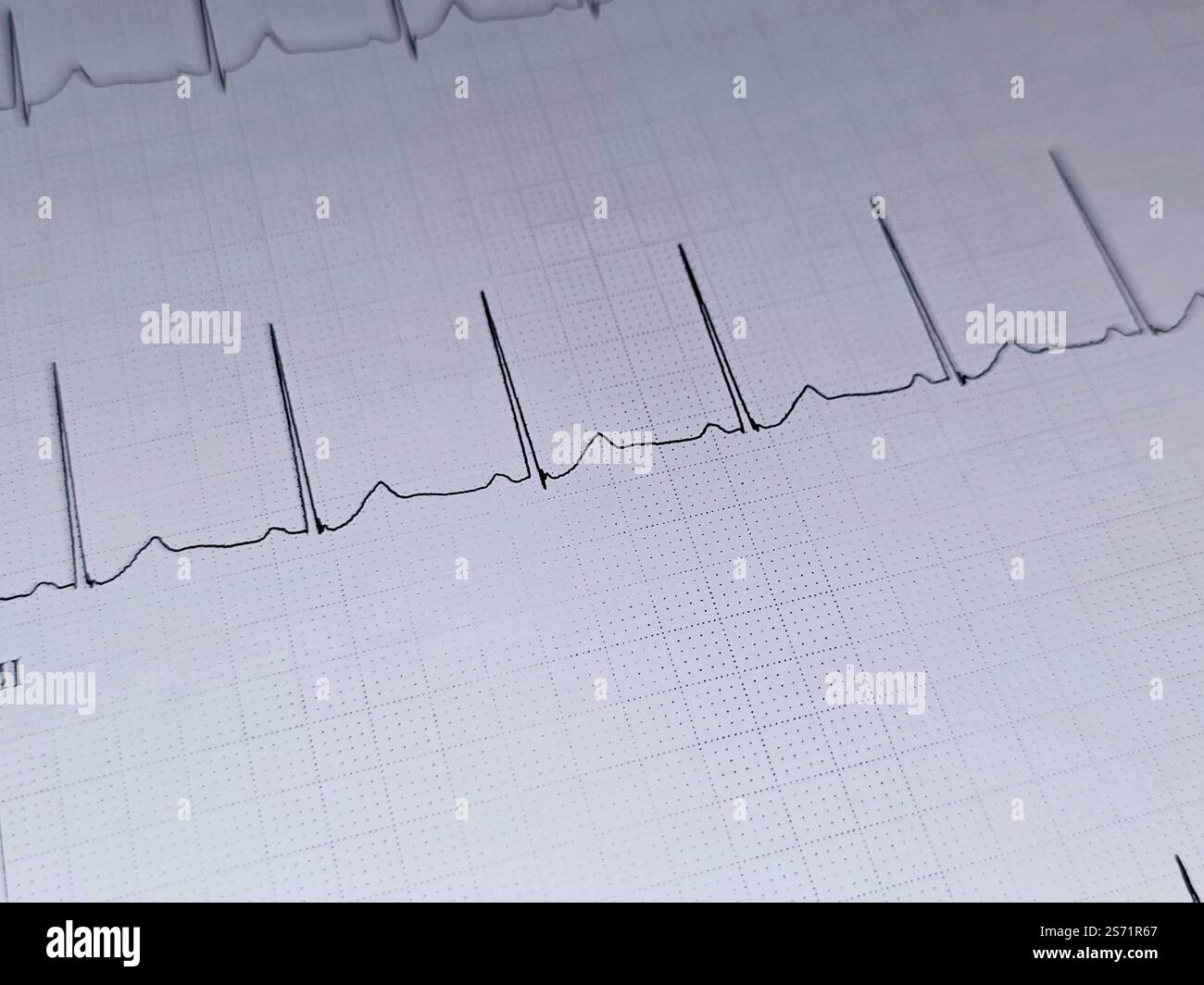 an electrocardiogram ECG or EKG, within normal ECG for a 55 years old male, a recording of the ...