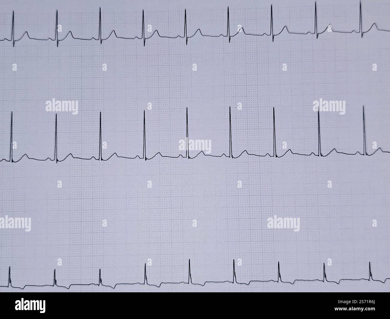 Normal ecg hi-res stock photography and images - Alamy