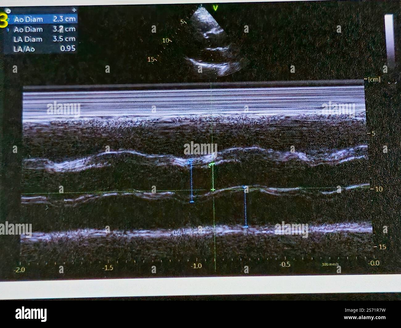 Echocardiography or cardiac ultrasound shows normal values except for ...