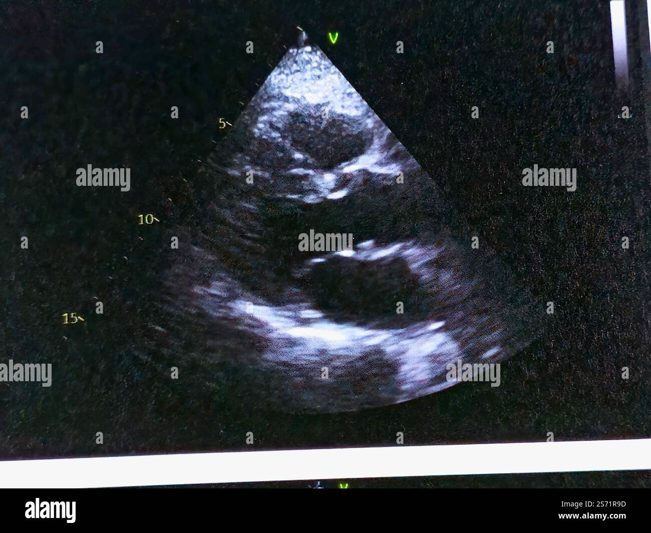 Echocardiography or cardiac ultrasound shows normal values except for ...