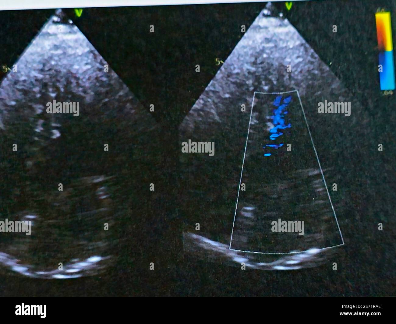 Echocardiography or cardiac ultrasound shows normal values except for ...