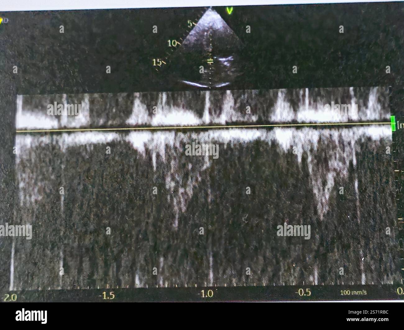 Echocardiography or cardiac ultrasound shows normal values except for ...