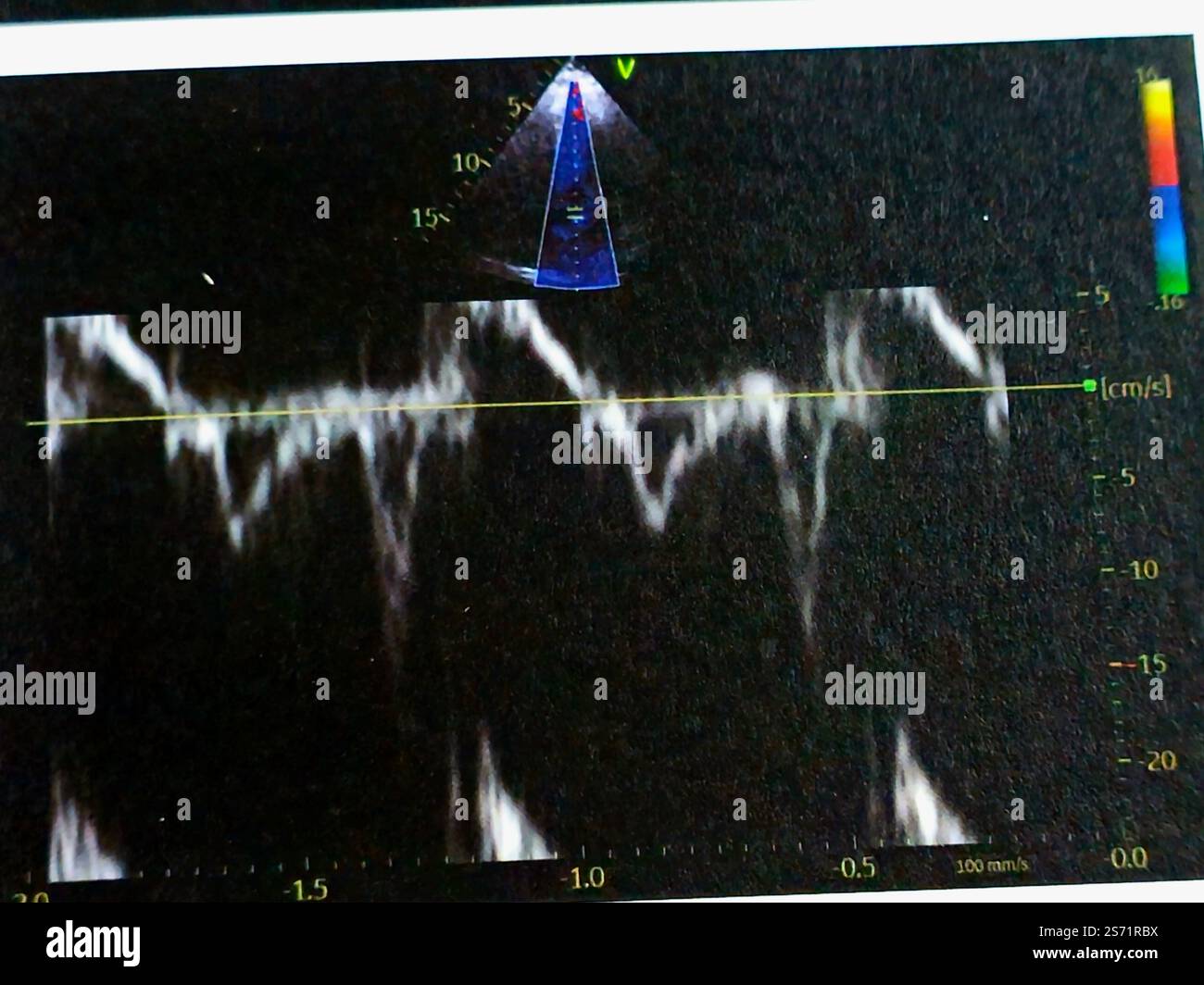 Echocardiography or cardiac ultrasound shows normal values except for ...