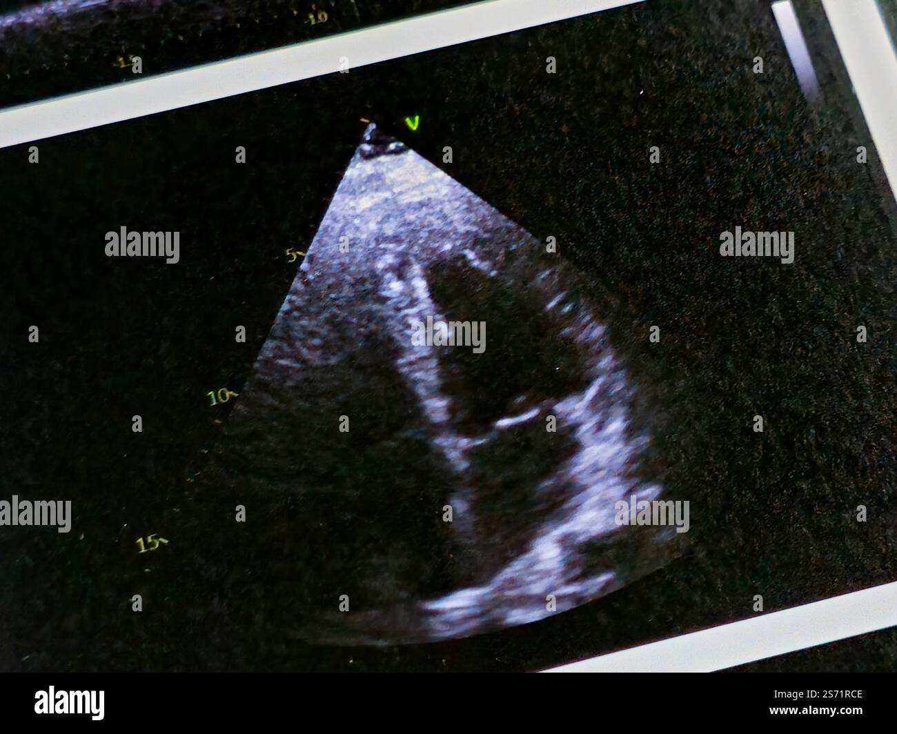 Echocardiography Or Cardiac Ultrasound Shows Normal Values Except For