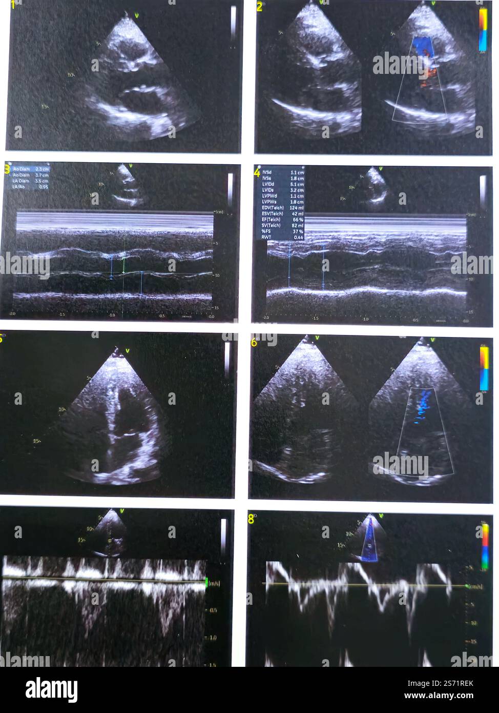 Echocardiography or cardiac ultrasound shows normal values except for ...
