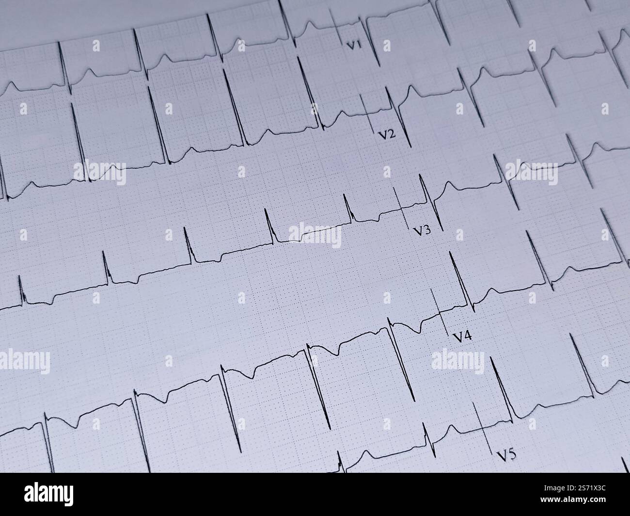 an electrocardiogram ECG or EKG, within normal ECG for a 55 years old ...