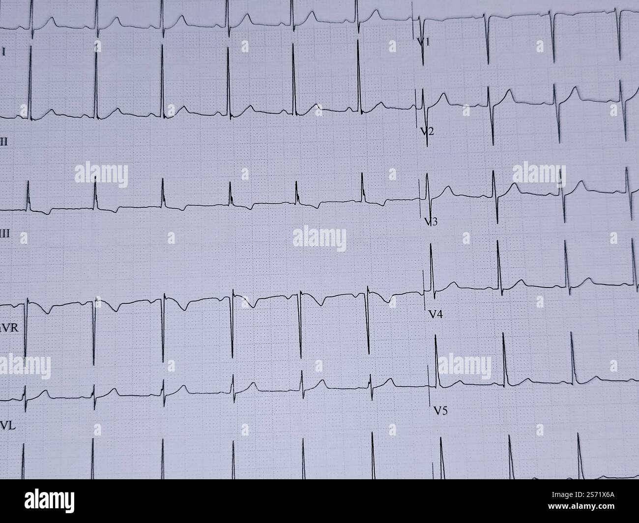 An Electrocardiogram Ecg Or Ekg Within Normal Ecg For A 55 Years Old