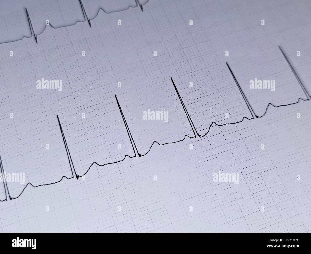 An Electrocardiogram Ecg Or Ekg Within Normal Ecg For A 55 Years Old