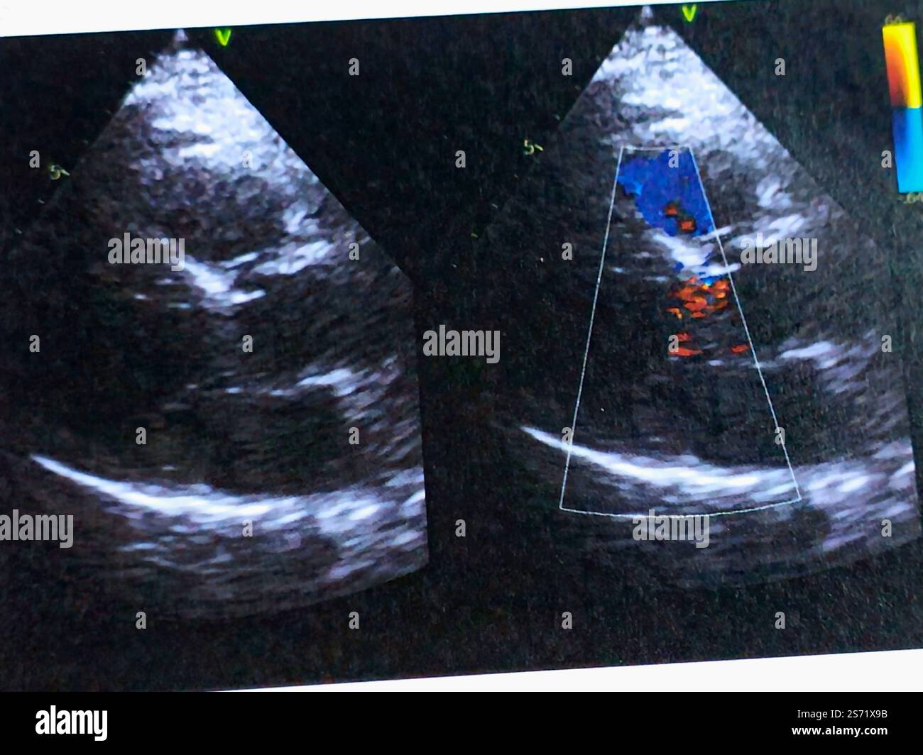 Echocardiography or cardiac ultrasound shows normal values except for ...