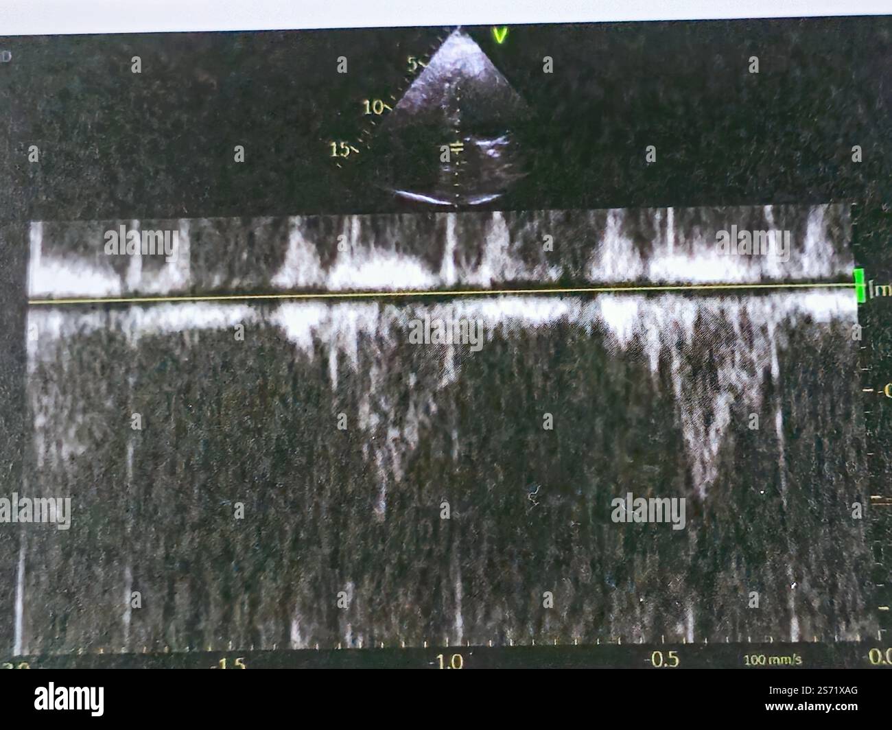 Echocardiography or cardiac ultrasound shows normal values except for ...