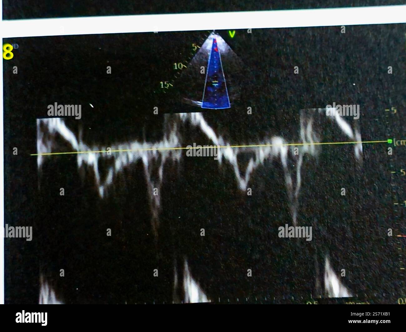 Echocardiography or cardiac ultrasound shows normal values except for ...